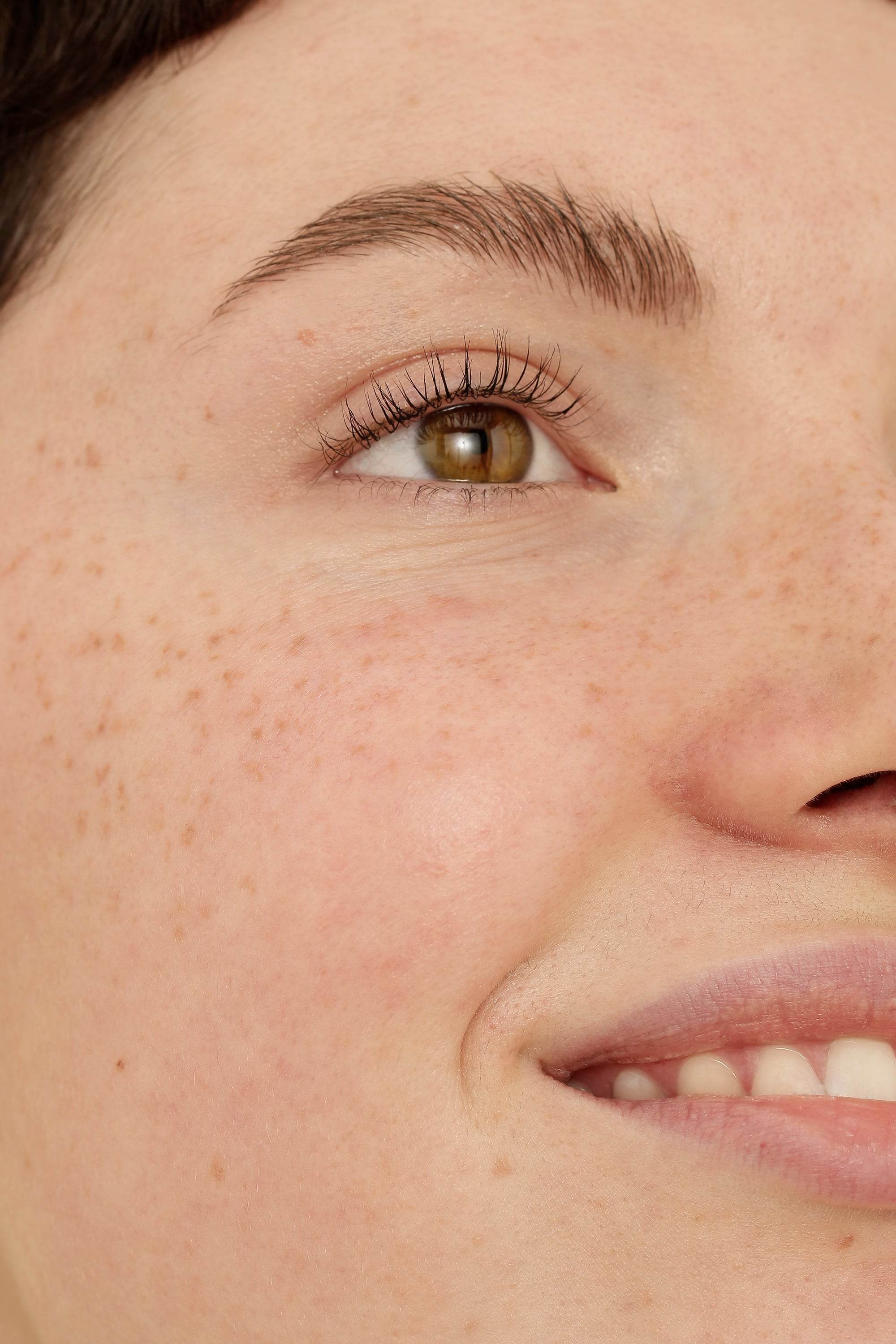 Couperose, rosacée : comment apaiser les rougeurs sur le visage