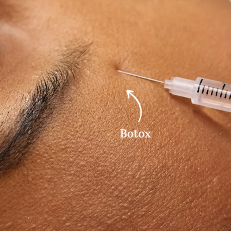 Injections de botox et d'acide hyaluronique : quelles différences